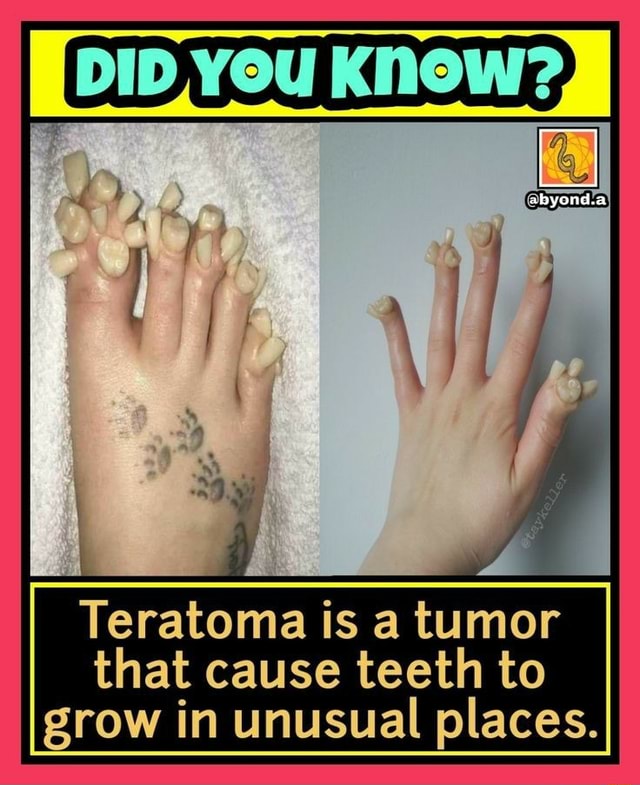 DID You Know? Teratoma is a tumor that cause teeth to grow in unusual ...
