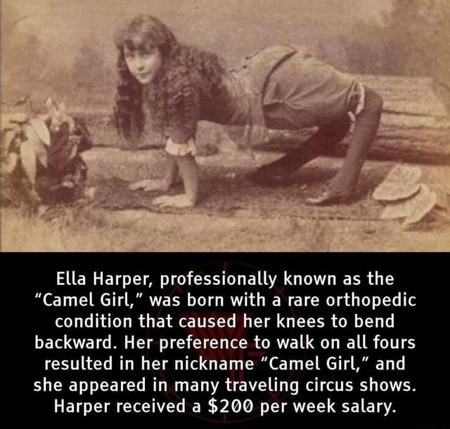 Ella Harper Professionally Known As The Camel Girl Was Born With A
