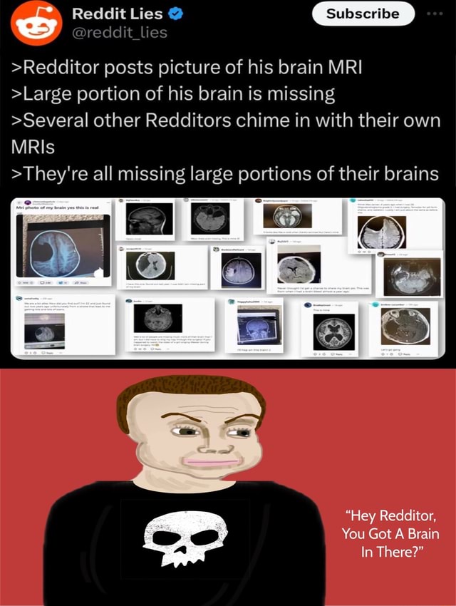 Eddit_lies >Redditor posts picture of his brain MRI >Large portion of ...
