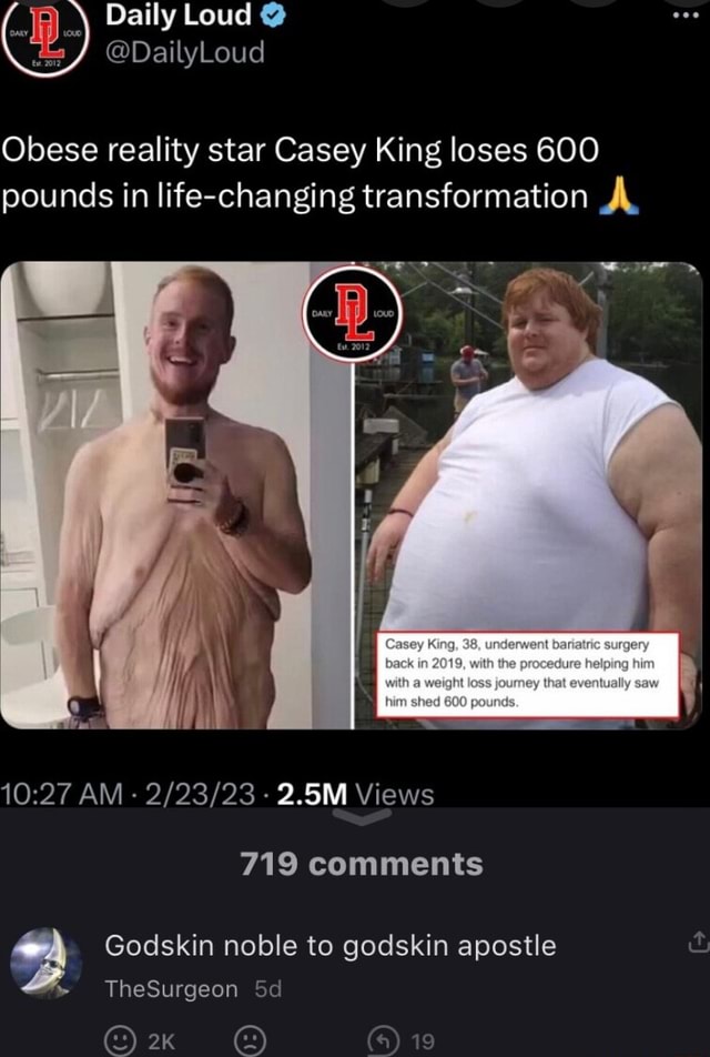 D- Daily Loud @ @DailyLoud Obese reality star Casey King loses 600 ...