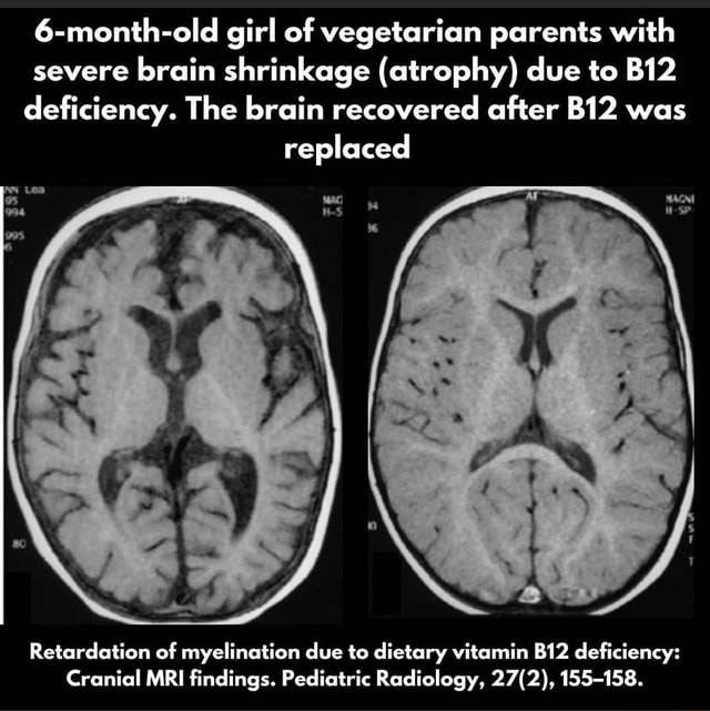 6-month-old girl of vegetarian parents with severe brain shrinkage ...