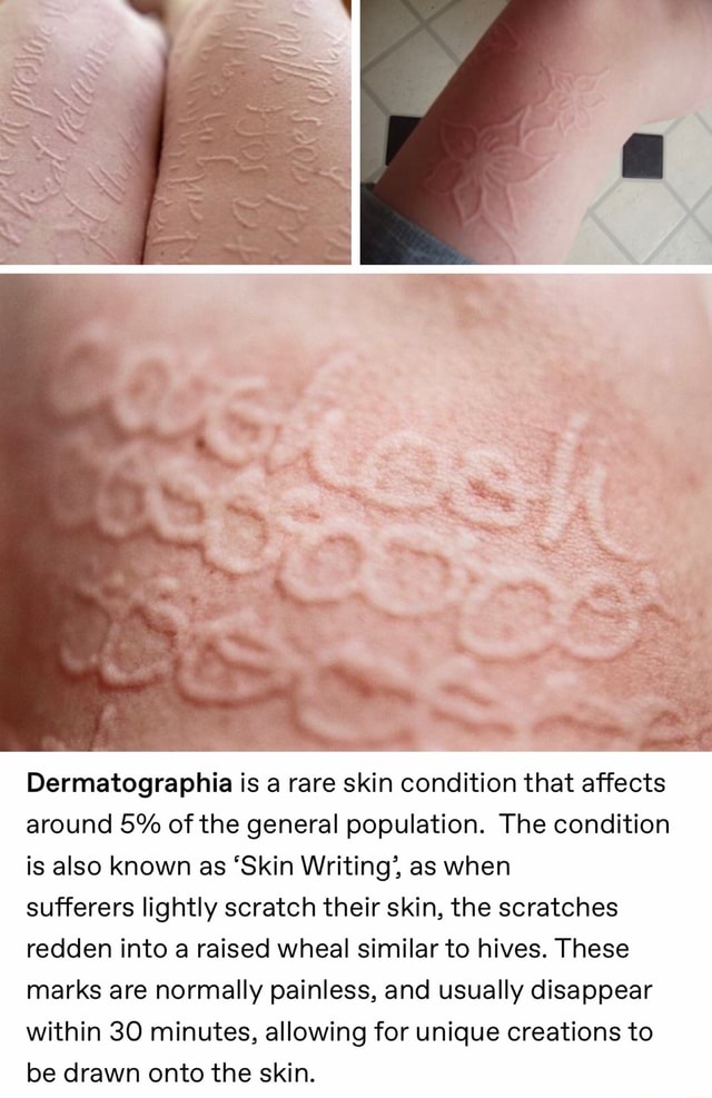 Dermatographia is a rare skin condition that affects around 5% of the ...