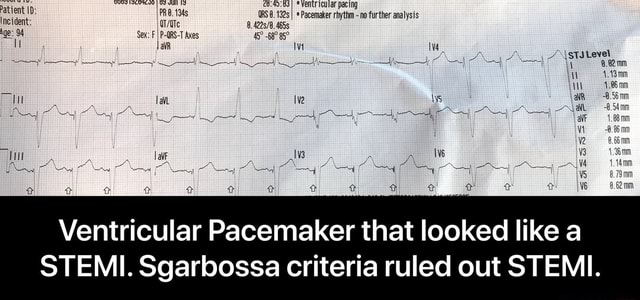 Ventricular Pacemaker that looked like a STEMI. Sgarbossa criteria ...
