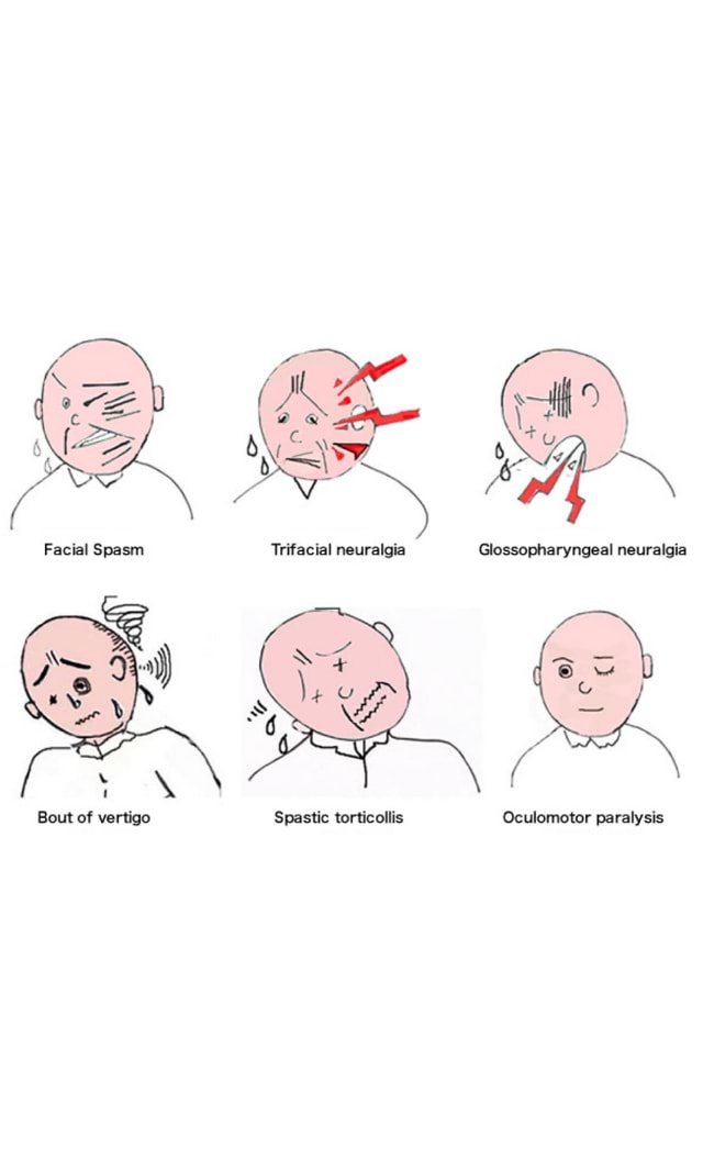 Bout of vertigo Spastic torticollis Oculomotor paralysis - iFunny
