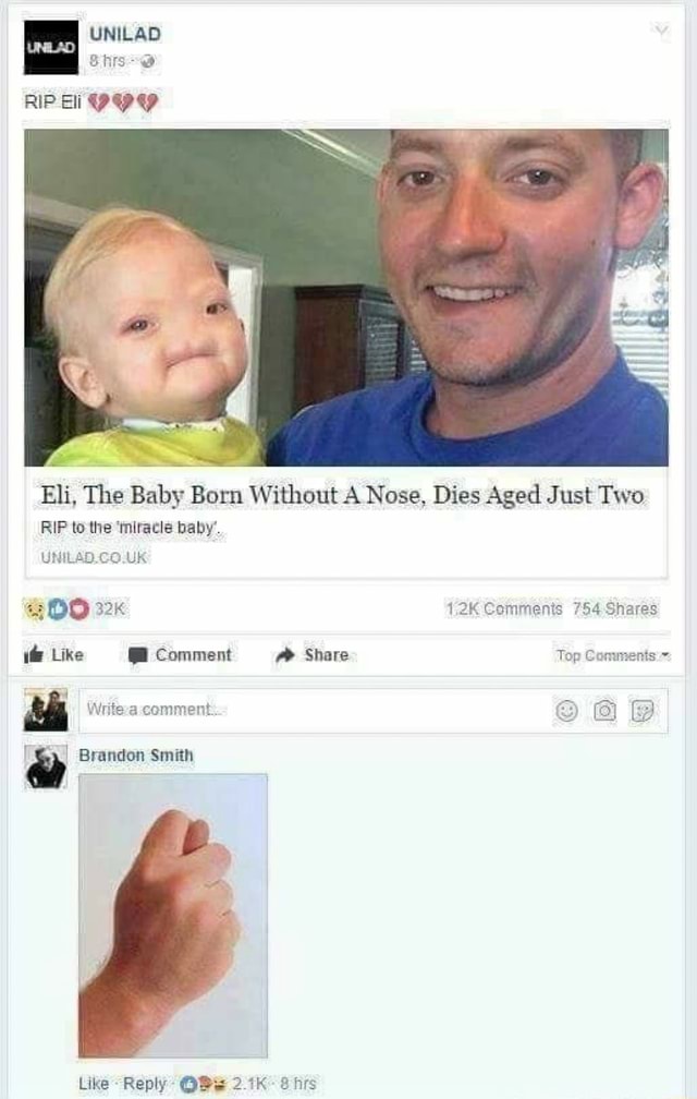 Eli, The Baby Born Without A Nose, Dies Aged Just Two RIP to the ...