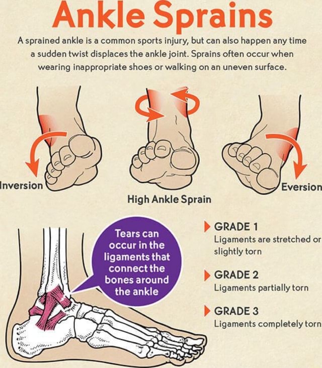 Ankle Sprains A sprained ankle is a common sports injury, but can also ...