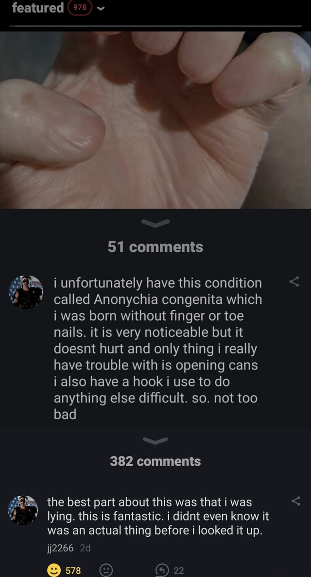 Featured 51 comments i unfortunately have this condition