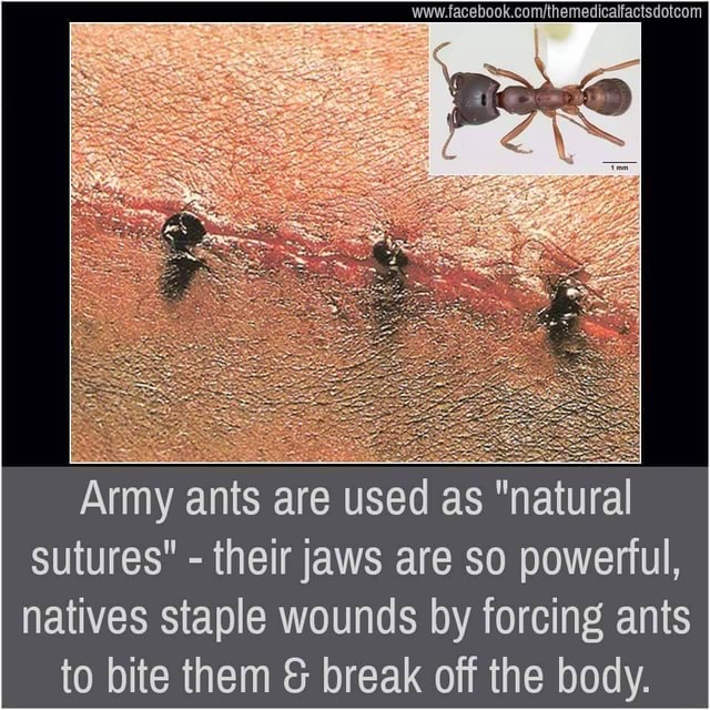 Leaving Us In Stitches - facebook .comithemedicalfactsdotcom Army ants ...