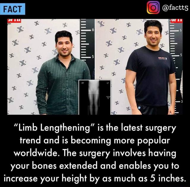 FACT "Limb Lengthening" is the latest surgery trend and is becoming ...