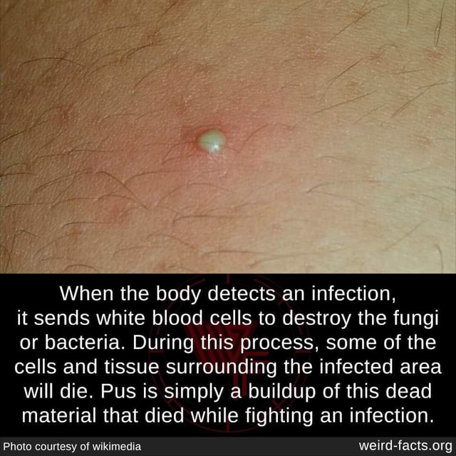 When the body detects an infection, it sends white blood cells to ...