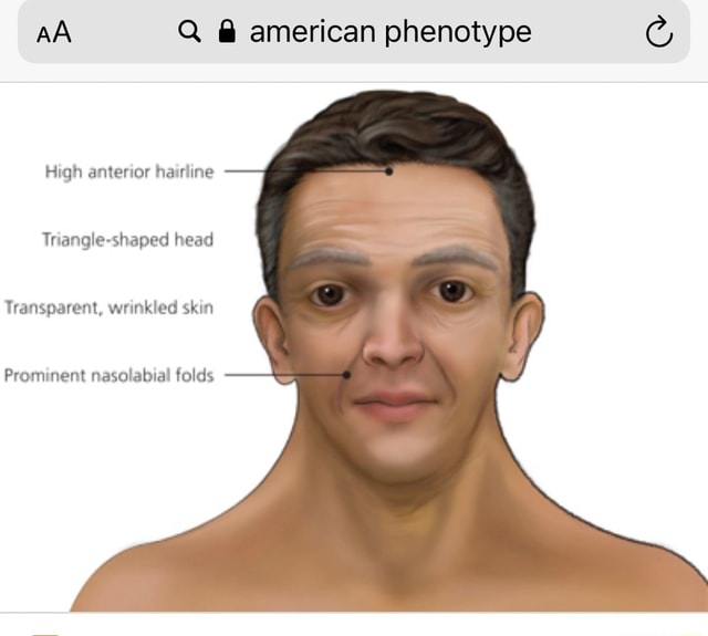 AA Q @ american phenotype GG High anterior hairline Triangle-shaped ...
