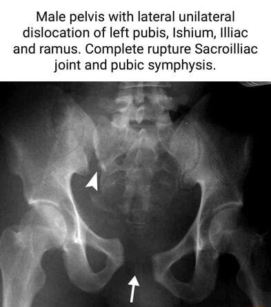 Male pelvis with lateral unilateral dislocation of left pubis, Ishium ...