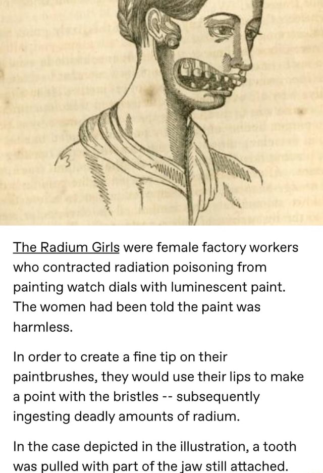 The Radium Girls were female factory workers who contracted radiation ...