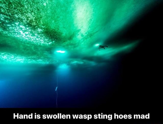 Hand is swollen wasp sting hoes mad - Hand is swollen wasp sting hoes ...