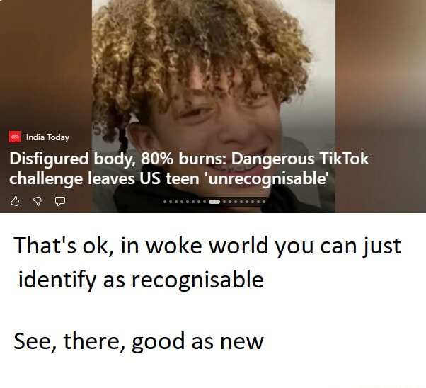 India Today Disfigured body, 80% burns: Dangerous TikTok challenge ...
