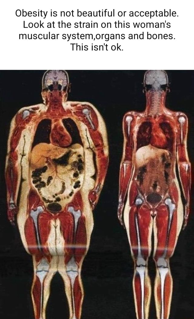 Obesity is not beautiful or acceptable. Look at the strain on this ...