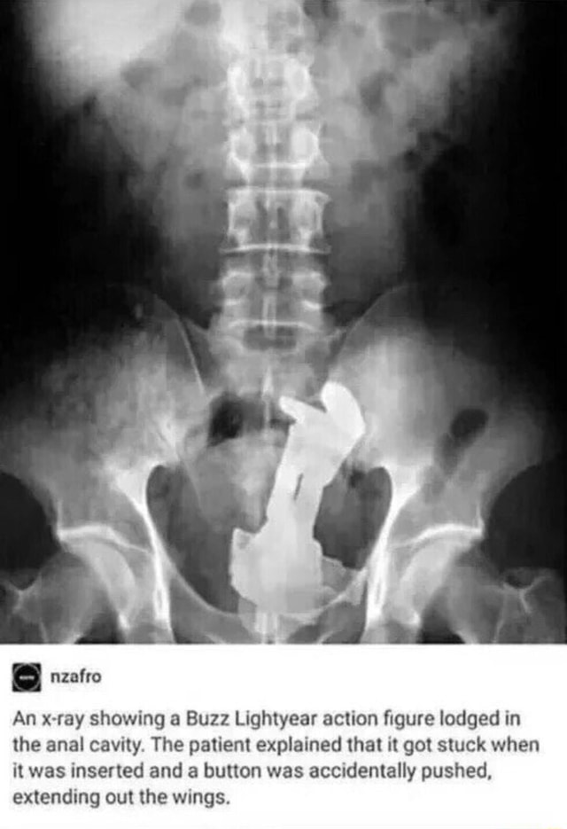 S Nzafro An X Ray Showing A Buzz Lightyear Action Figure Lodged In The
