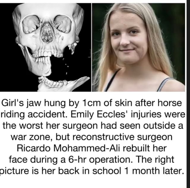 Girl's jaw hung by icm of skin after horse riding accident. Emily ...
