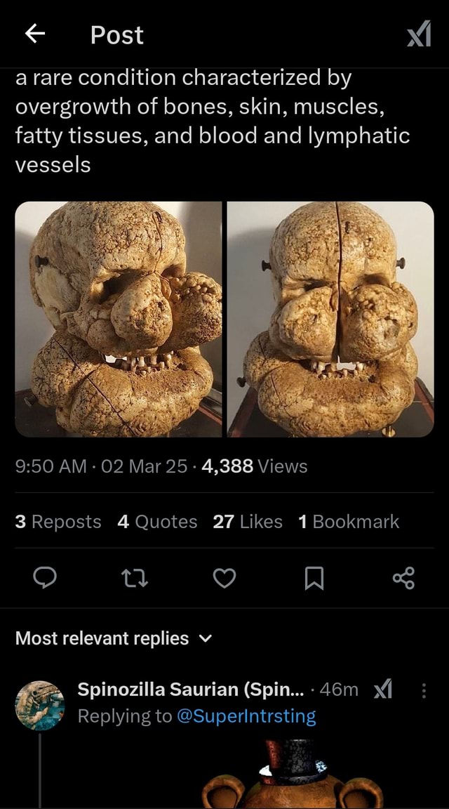 Post Mi a rare condition characterized by overgrowth of bones, skin ...