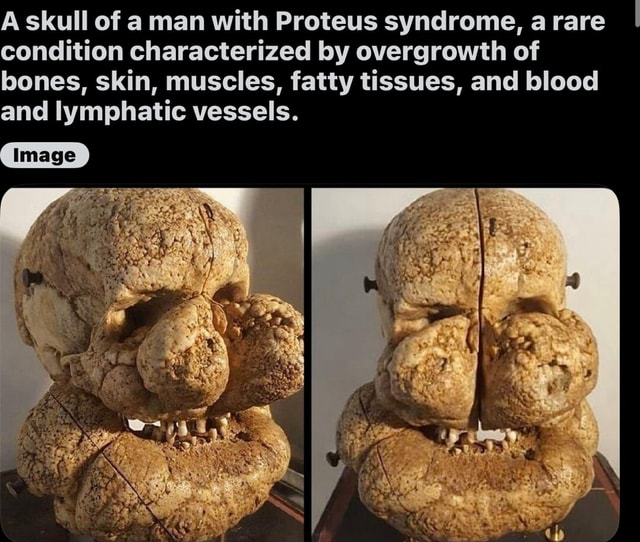 A skull of a man with Proteus syndrome, a rare condition characterized ...