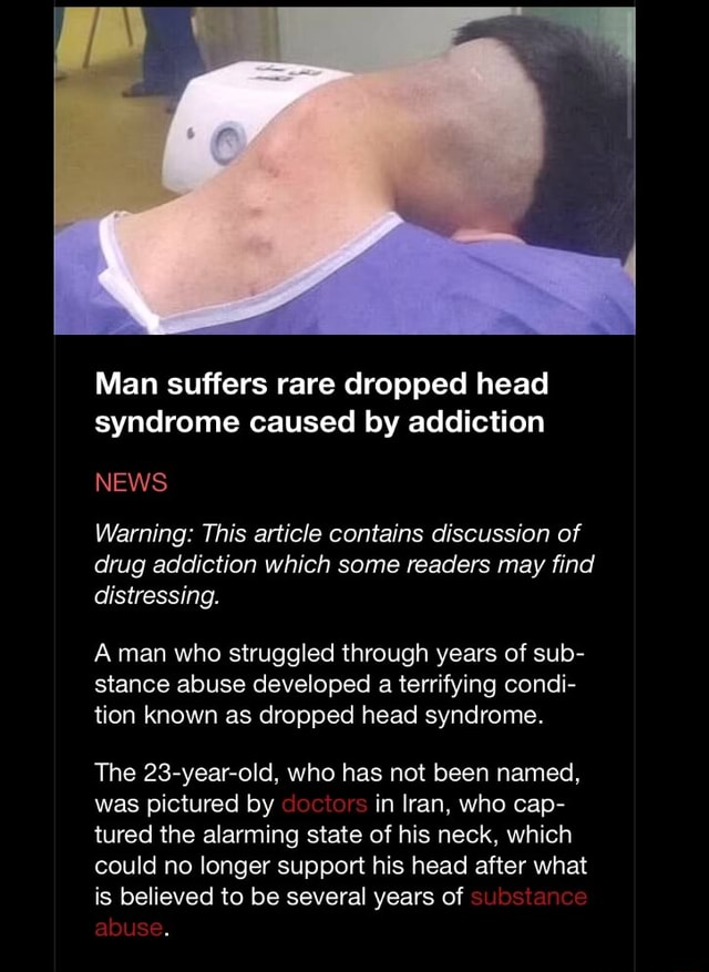 Man suffers rare dropped head syndrome caused by addiction NEWS Warning ...