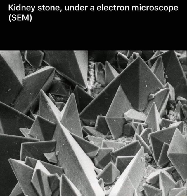 Kidney stone, under a electron microscope - seo.title