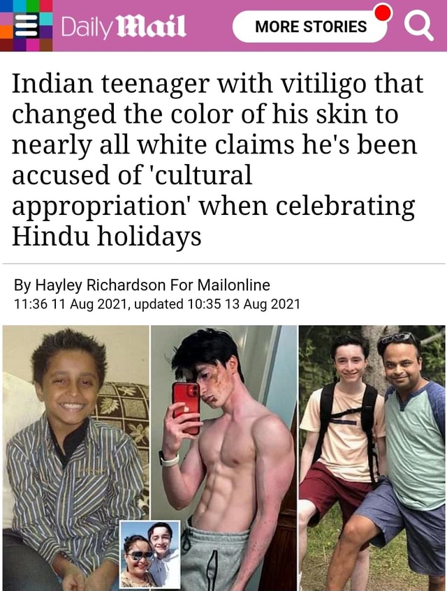= Mail MORE STORIES Indian teenager with vitiligo that changed the ...