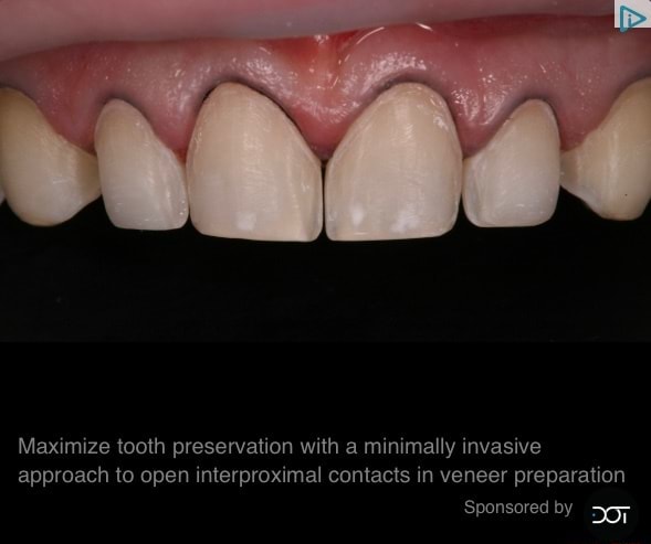 Maximize tooth preservation with a minimally invasive approach to open ...