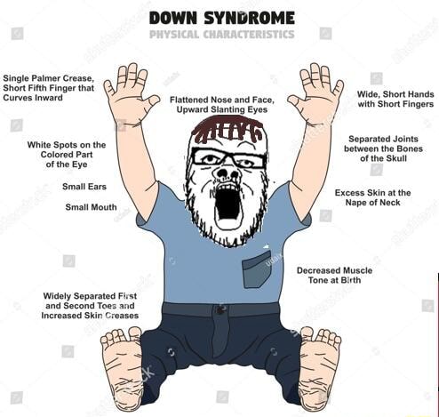 A24 down syndrome - DOWN SYNDROME Single Palmer Crease, Short Fith ...