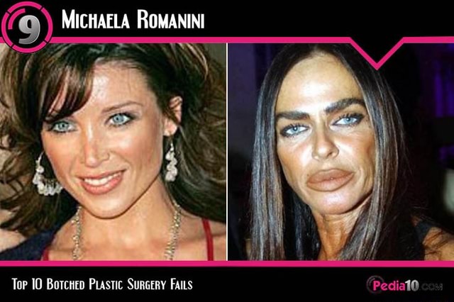 Top 10 Botched Plastic Surgery Fails - BEFORE AND AFTER - Toe 10 ...
