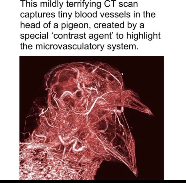 This mildly terrifying CT scan captures tiny blood vessels in the head ...