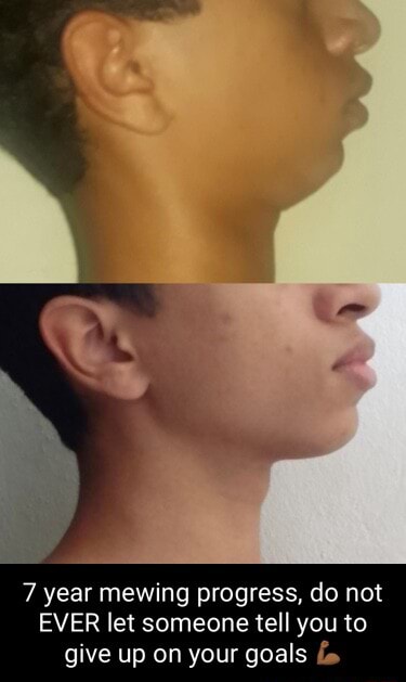 AS 7 year mewing progress, do not EVER let someone tell you to give up ...