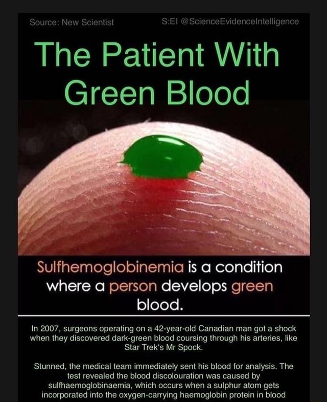 Source: New Sc me The Patient With Green Blood Sulfhemoglobinemia is a ...