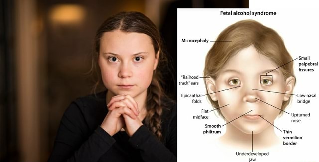 Fetal alcohol syndrome Microcephaly Fetal alcohol syndrome Microcephaly