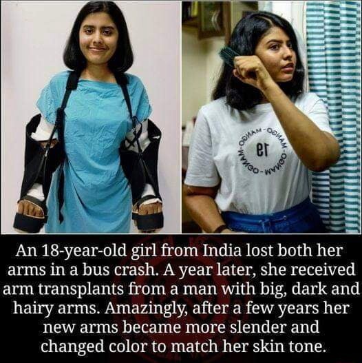 An 18-year-old girl from India lost both her arms in a bus crash. A ...