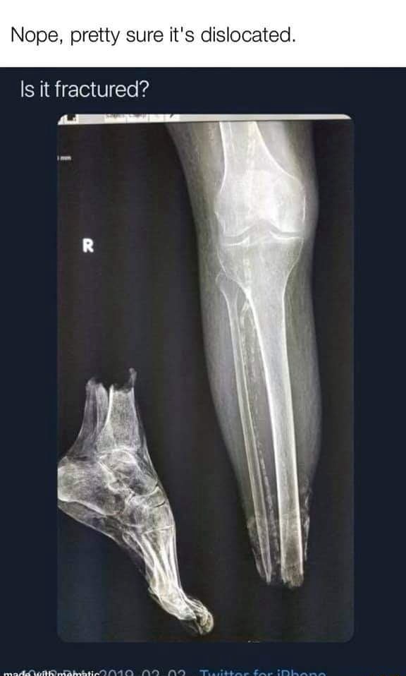 Nope, pretty sure it's dislocated. ls it fractured? - iFunny