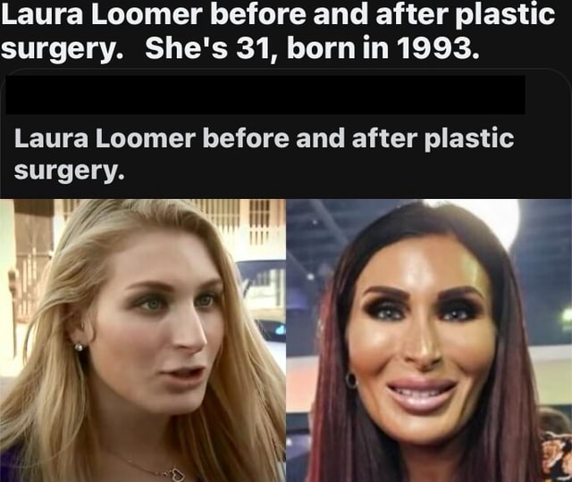 Laura Loomer before and after plastic surgery. She's 31, born in 1993 ...