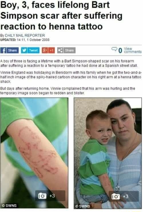Boy, 3, faces lifelong Bart Simpson scar after suffering reaction to ...