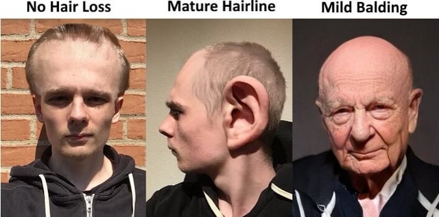 No Hair Loss Mature Hairline Mild Balding - iFunny