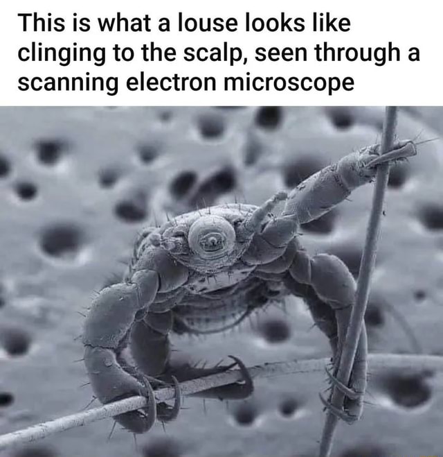 This is what a louse looks like clinging to the scalp, seen through a ...