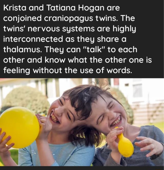 Krista & Tatiana Hogan - Krista and Tatiana Hogan are conjoined ...