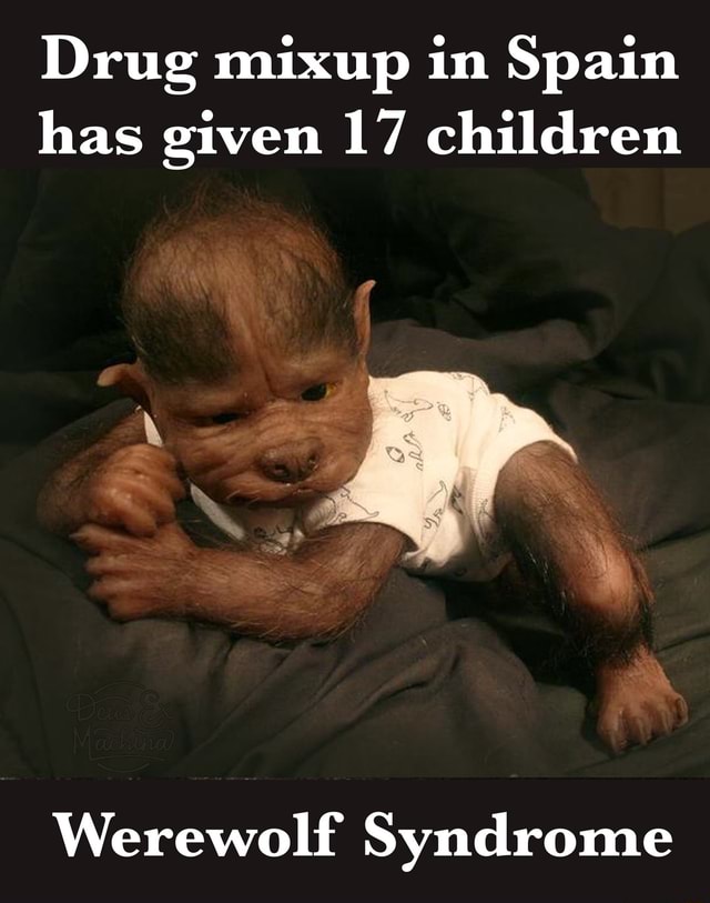 Drug mixup in Spain has given 17 children Werewolf Syndrome - iFunny