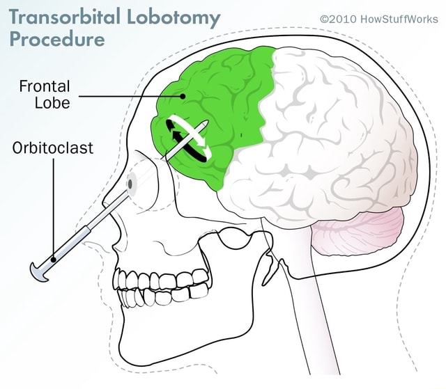 Transorbital Lobotomy HowstuttWorks Procedure Frontal Lobe Orbitoclast ...