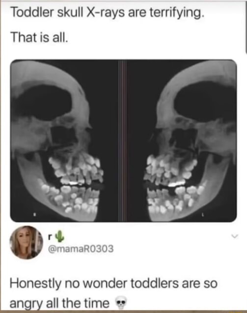Toddler skull X-rays are terrifying. That is all. Honestly no wonder ...