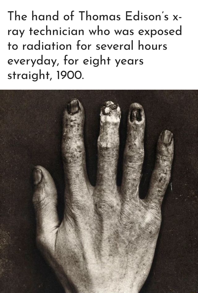 The hand of Thomas Edison's x- ray technician who was exposed to ...