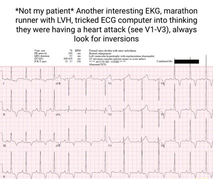 *Not my patient* Another interesting EKG, marathon tunner with LVH ...