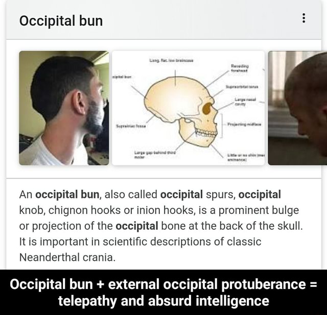 Occipital bun An occipital bun, also called occipital spurs, occipital ...