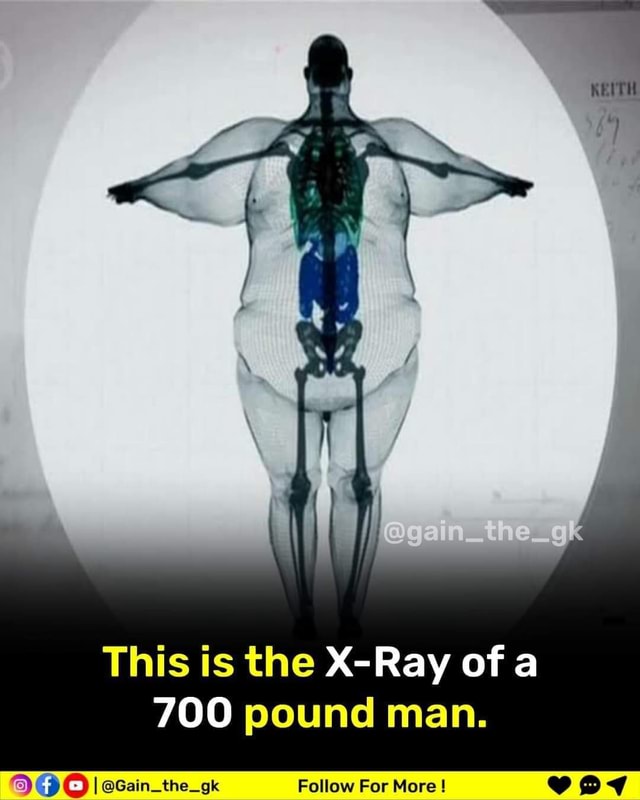 This is the X-Ray of a 700 pound man. Ca PAI mein the Calinus Car Maro ...