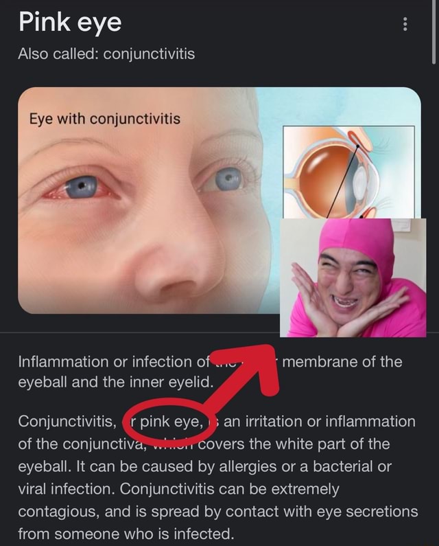 Pink eye Also called: conjunctivitis Eye with conjunctivitis ...