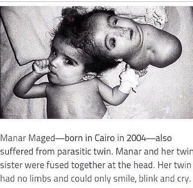 Manar Maged-born in Cairo in ZOOA-also suffered from parasitic twin ...